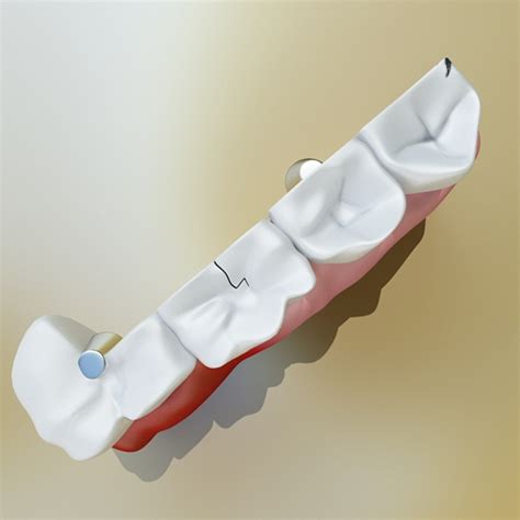 Teeth Pathologies Tooth 3d 3ds