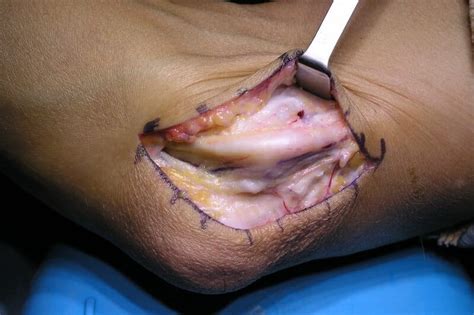 Nerf Ulnaire Au Coude Nerf Cubital Trajet Compression Libération