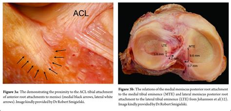 Asian Journal Of Arthroscopy Meniscal Root Tears Current Concepts