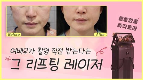 즉각적인 리프팅 여배우들이 촬영 전에 꼭 시술받는다는 레이저의 정체는 Whats The Laser Treatment