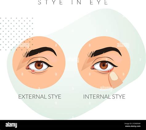 External And Internal Stye In The Eyes Stock Illustration As Eps 10 File Stock Vector Image