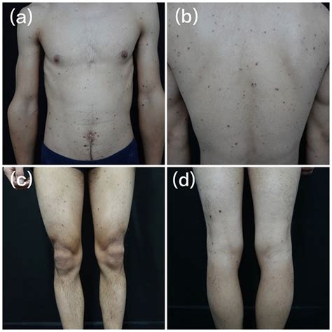 Multiple Eruptive Dermatofibroma A Case Report Ccid