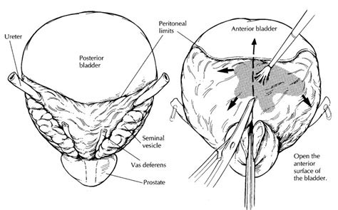 Bladder Dissection