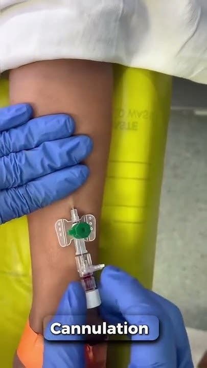 Cannulation Youtube