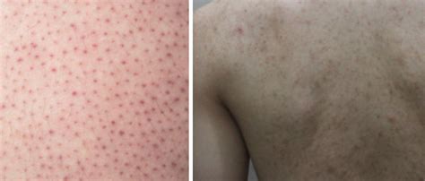 Primi Clinic 鸡皮肤・毛孔角化症的治疗与居家护理方法3选