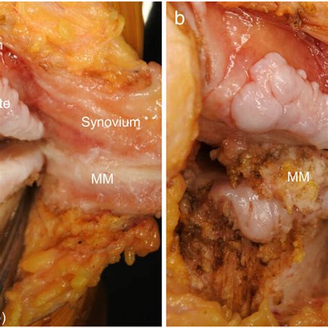 Anatomical Relationship Between The Tibial Osteophyte Width And The Mm