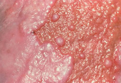 Burns Assessment And Treatment The Pharmaceutical Journal