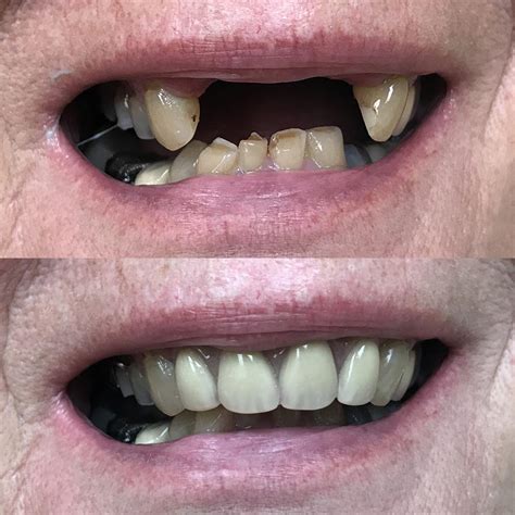 Partial Denture Pictures Before And After At Alfredo Montano Blog