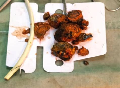 Biliary Prosthesis And Multiple Extracted Stones Download Scientific