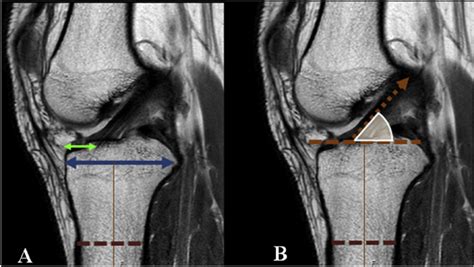 Normal Mri Knee