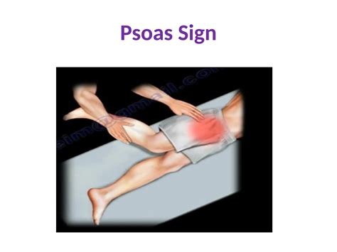 Acute Appendicitis And Homoeopathy Pptx