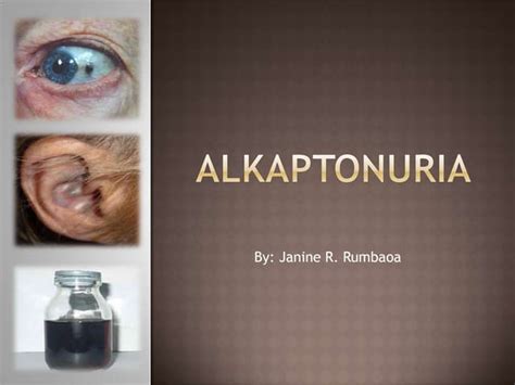 Alkaptonuria Pptx