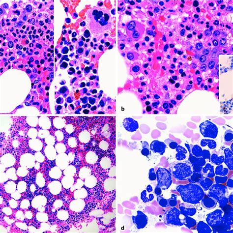 Case 2 Clonal Cytopenia Of Undetermined Significance Ccus And