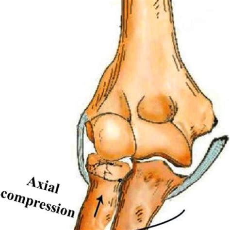Radial Head Fractures With Avulsion Of The Medial Collateral Ligament
