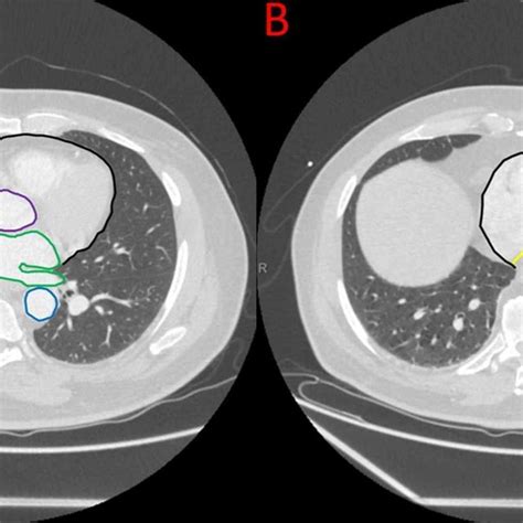 Ct Of The Chest Showing Two Pulmonary Artery Avms In The Axial Field Of