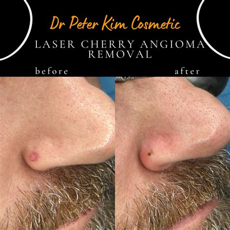 Cherry Hemangioma Flat