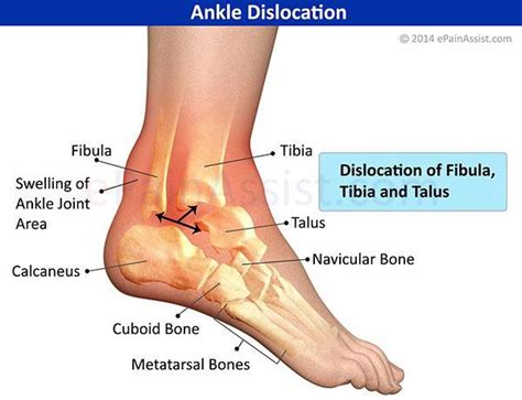 Ankle Dislocation Diagram