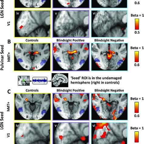 seed region correlation maps for human motion area hmt in patients