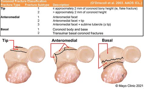 Classification Of Elbow Fractures At Jesus Hepner Blog