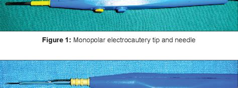 Figure 1 From Modified Microdissection Electrocautery Needle Semantic