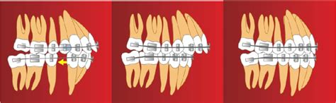 Classic Pattern Extraction Of 15 25 34 And 44 In Order To Increase