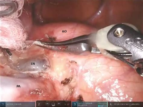 The Technique Of Robotic Anatomic Pulmonary Segmentectomy Ii Left