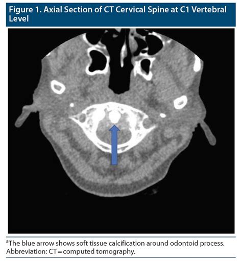 Crowned Dens Syndrome Masked As Meningitis