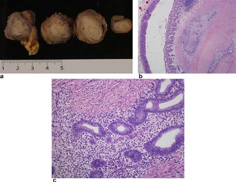 Histopathological Examination A Gross Examination Of The Appendectomy Download Scientific