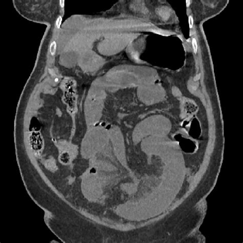 Dilated Small Bowel Loops With A Transition Zone Bowel Thickening And