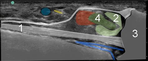 Foot And Ankle Peroneus Brevis Split Tear 2 Image Sonosite Institute