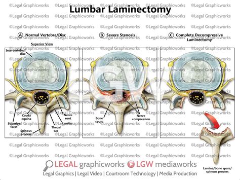 Lumbar Laminectomy Lgwgo