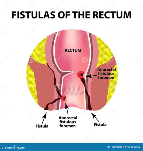 Paraproctitis Stock Illustrations 22 Paraproctitis Stock Illustrations Vectors And Clipart