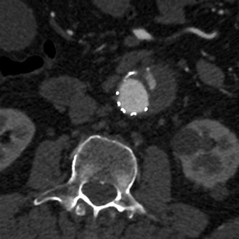 Cta 1 Year After The Evar Showing Leaking Contrast At The Anterior Face Download Scientific