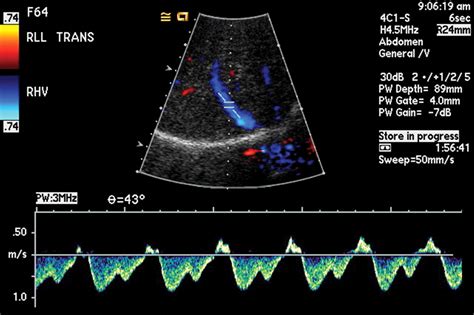 What Does A Venous Doppler Show At Thomas Lintz Blog