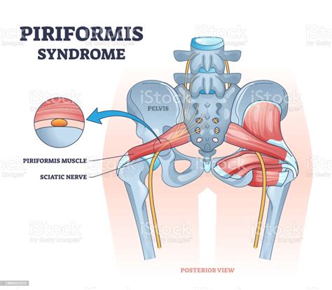 Sindrom Piriformis Dan Diagram Garis Besar Nyeri Kompresi Saraf Sciatic Ilustrasi Stok Unduh