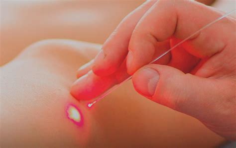 Endolaser Farmacêuticos Estão Respaldados Para Procedimento