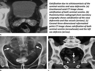 Presentation1pptx Radiological Imaging Of Bilaharziasis Pptx