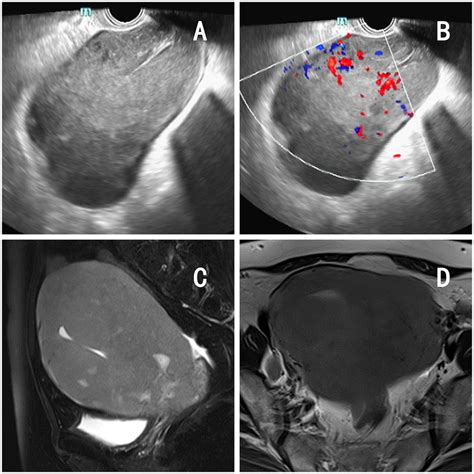 Imaging Findings Of The Patient A B Pelvic Ultrasound A 134 × 94