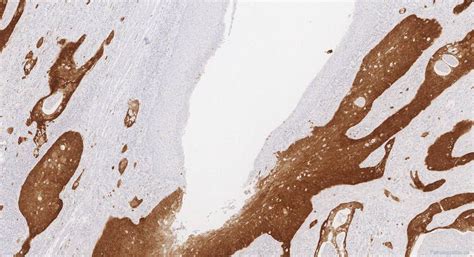 Hpv Associated Squamous Cell Carcinoma Of The Eye Ottawa Atlas Of Pathology