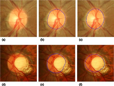 Peripapillary Atrophy In Glaucoma