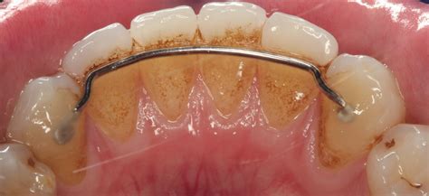Bonded Retainer Removal Fixed Bonded Retainer Upper Lower Bm