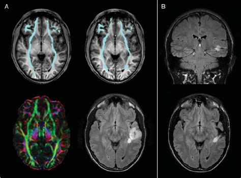 A A Case Of A Left Temporal Oligodendroglioma With A Deep Nodule Download Scientific Diagram