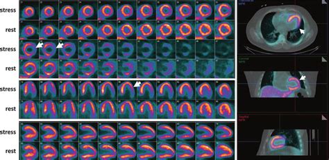 8 Left Panel Rest And Regadenoson Stress Myocardial Perfusion Petct