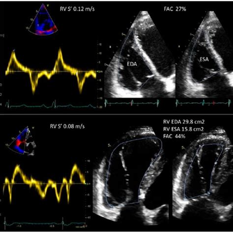 Volumetric Assessment Of Rv Function By Cmr Traces Of The Lv