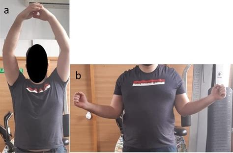 Locked Posterior Shoulder Dislocation Right Shoulder Postoperative