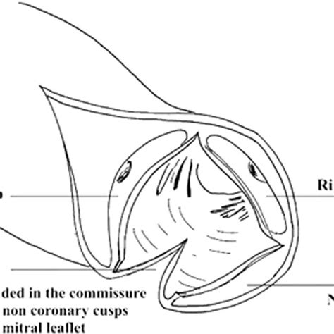 Anterior And Posterior Aortic Root Augmentation Incisions On The Left