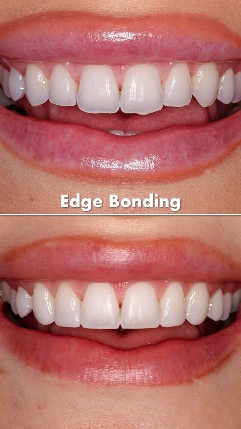 Composite Bonding Teeth Before And After