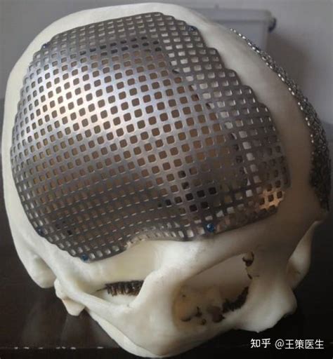 颅骨修补手术费用贵吗 知乎