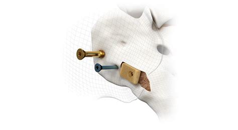 Nevro Aquires Vyrsa Technologies Orthoworld