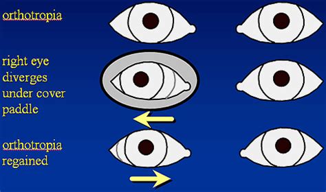 Cover Uncover Test For Latent Squint